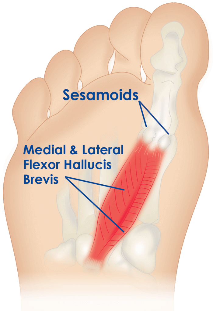 Sesamoiditis ICB Medical Sesamoiditis ICB Medical